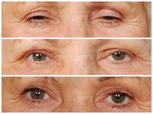 Ptóza očního víčka | Estheticon.cz