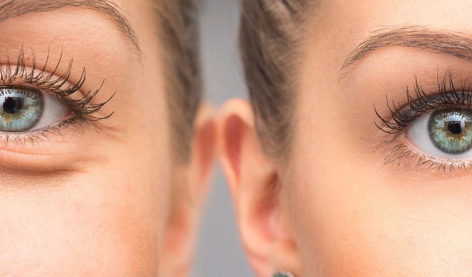 Ohrenkorrektur (Ohren anlegen) | Info- und Fachportal Estheticon.de