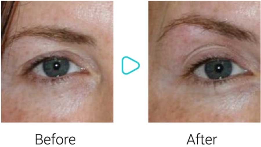 Temporal/ lateral brow lift - Operace obočí (Brow-lift) - Diskuze ...